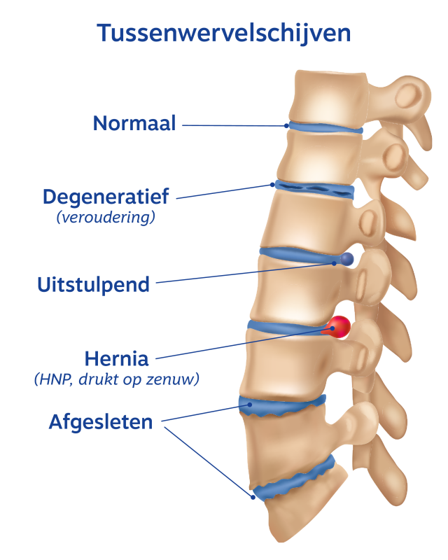 Hernia (rug en nek) - DC Klinieken