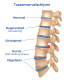Hernia (rug en nek) - DC Klinieken