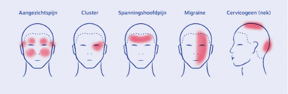 Hoofdpijn - DC Klinieken